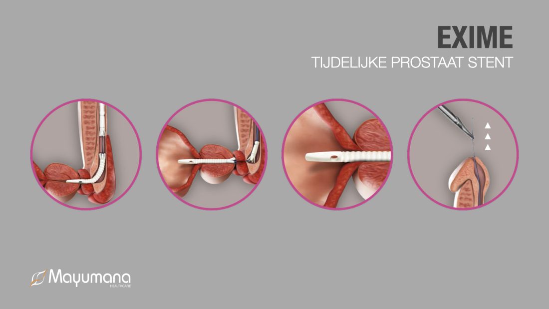Rezum procedure in combinatie met de EXIME stent - Mayumana Healthcare