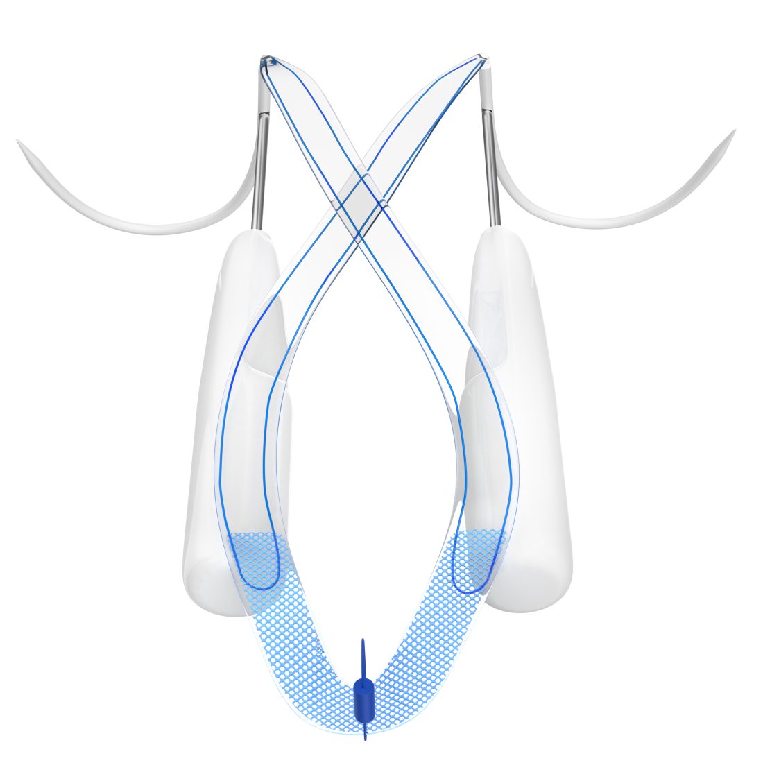 TVT Abbrevo® - Mayumana Healthcare